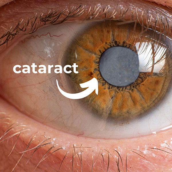 Cataract Diagnosis & Co-Management, Raleigh & Morrisville, NC