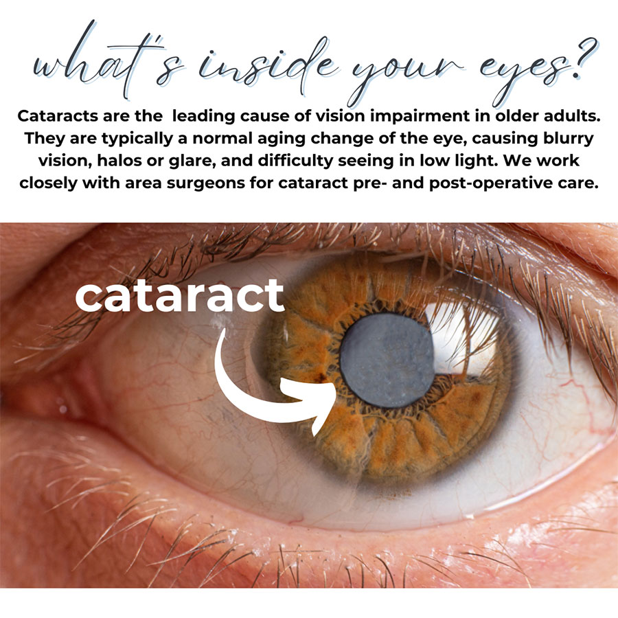 Cataract Diagnosis & Co-Management, Raleigh & Morrisville, NC